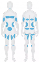 Cool­Sculpting® Kryoli­polyse – Plastische Chirurgie Dr. Kauder